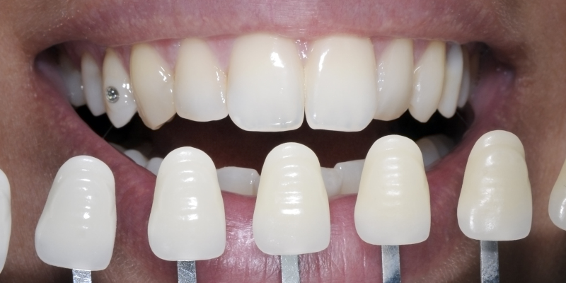 Fluoride Treatments, Clayton, NC | Dental Oasis of Clayton