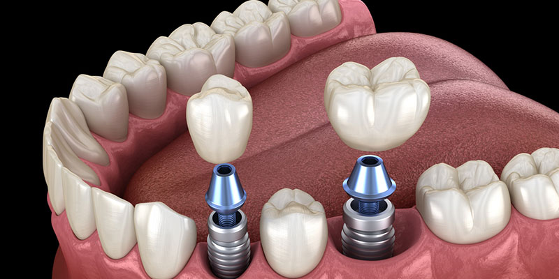 Understanding Dental Implants: Permanent Solutions for Missing Teeth ...